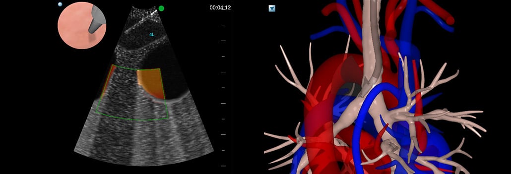 NIEZBĘDNE UMIEJĘTNOŚCI EBUS - Simedu