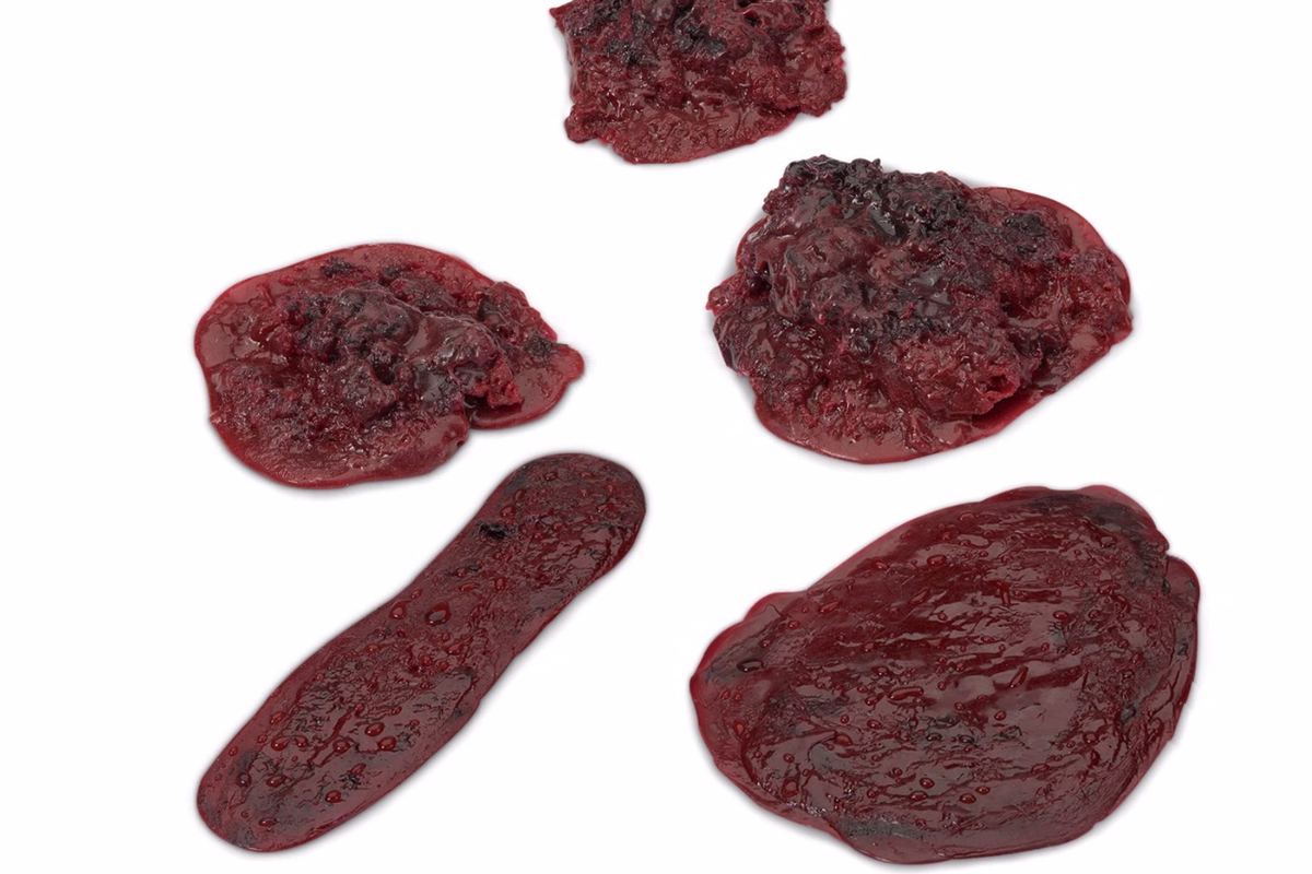 Zestaw modeli symulujących skrzepy oraz krwotok - Simedu